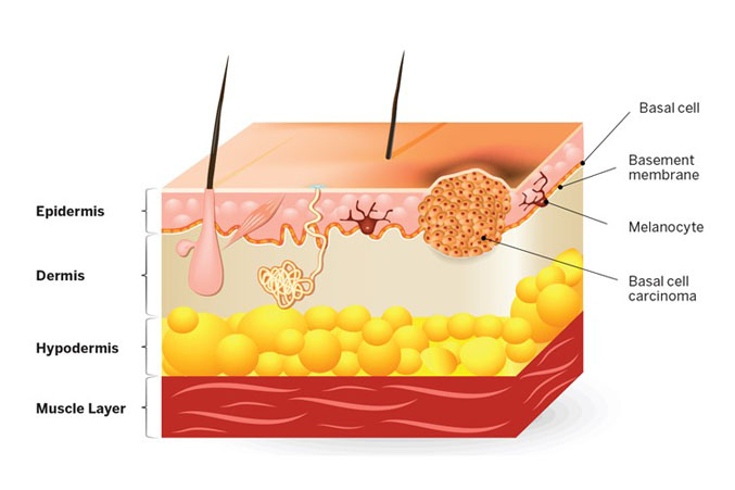 Melanoma Skin Cancer Diagram